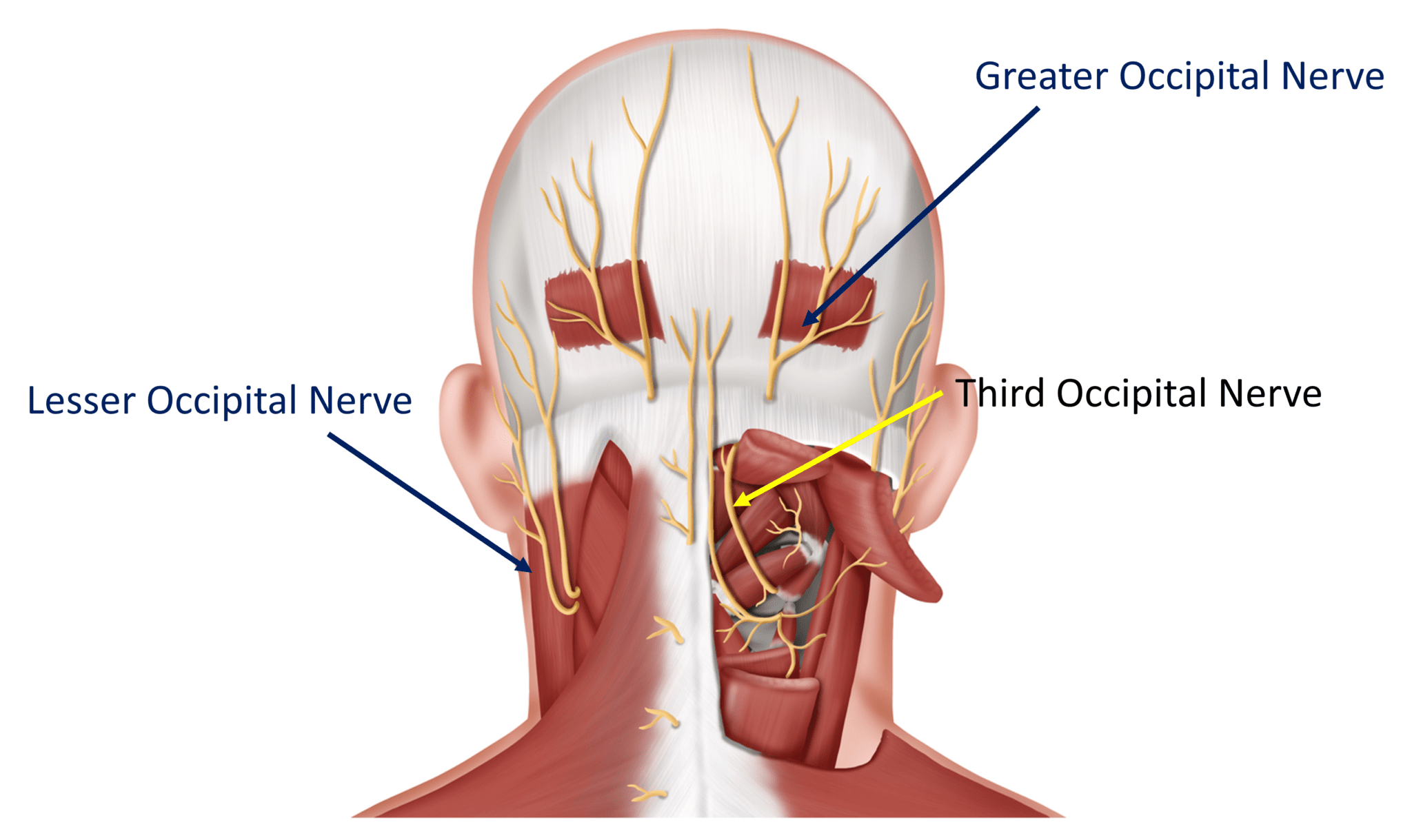 What Is a Proper Diagnostic Block Headache Work-up? - Regenexx