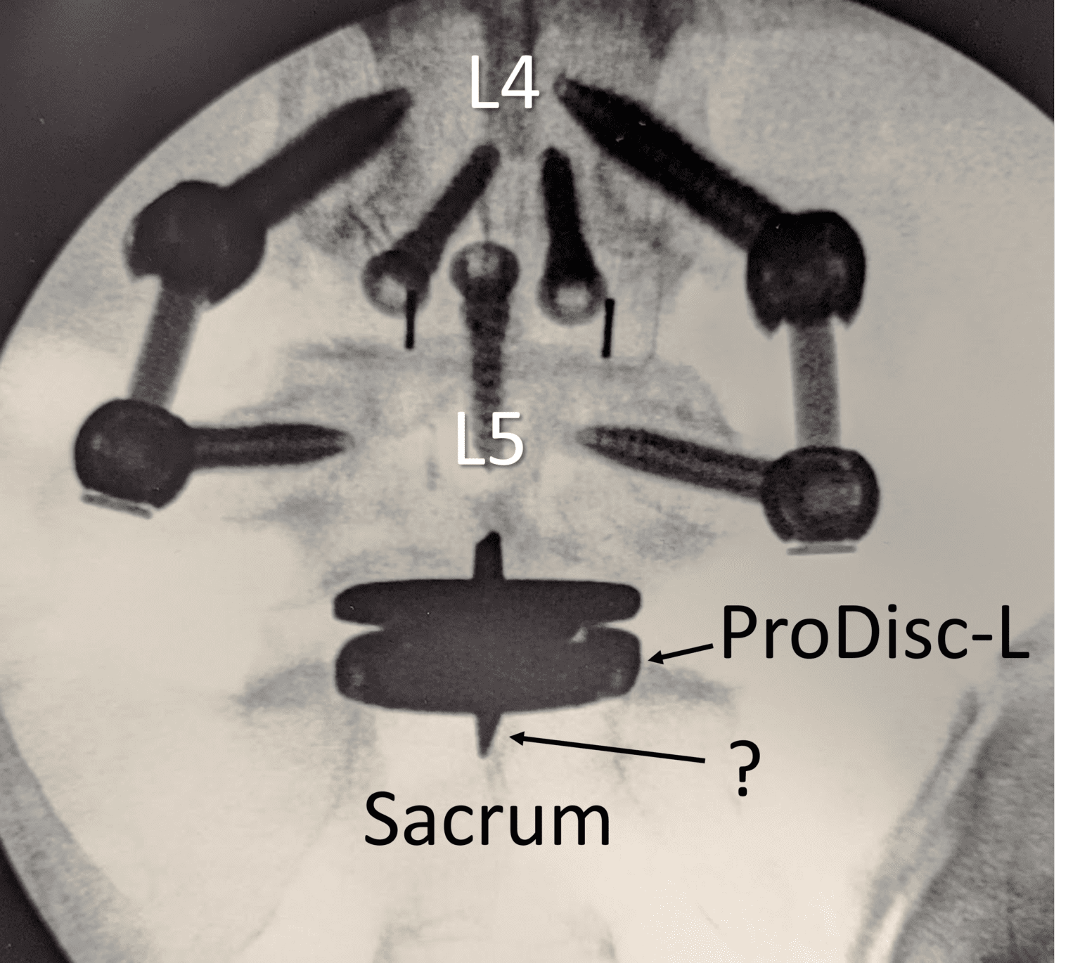 The Curious Case of the Bad Artificial Disc - Regenexx