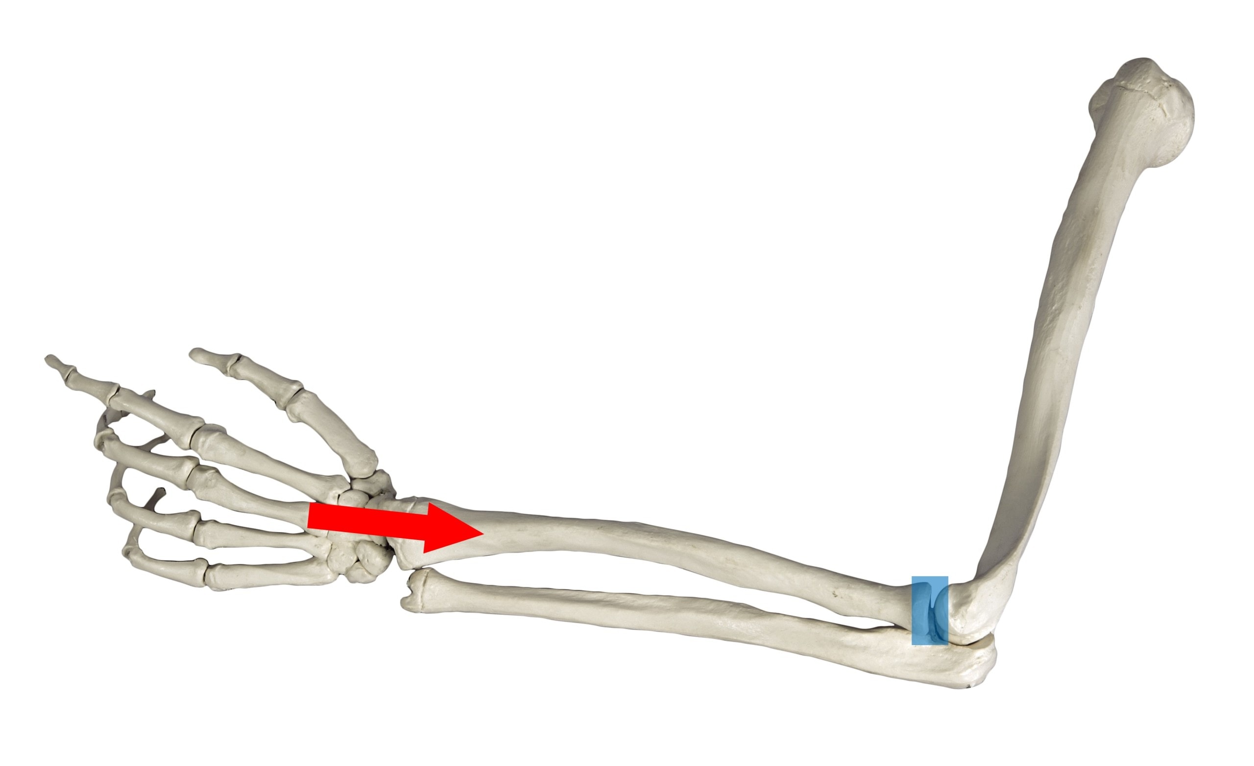 My Elbow and Getting on Top of Early Arthritis - Regenexx