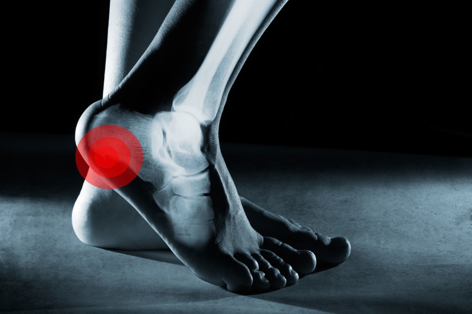 What Is a Plantar Fascia Tear? - Regenexx