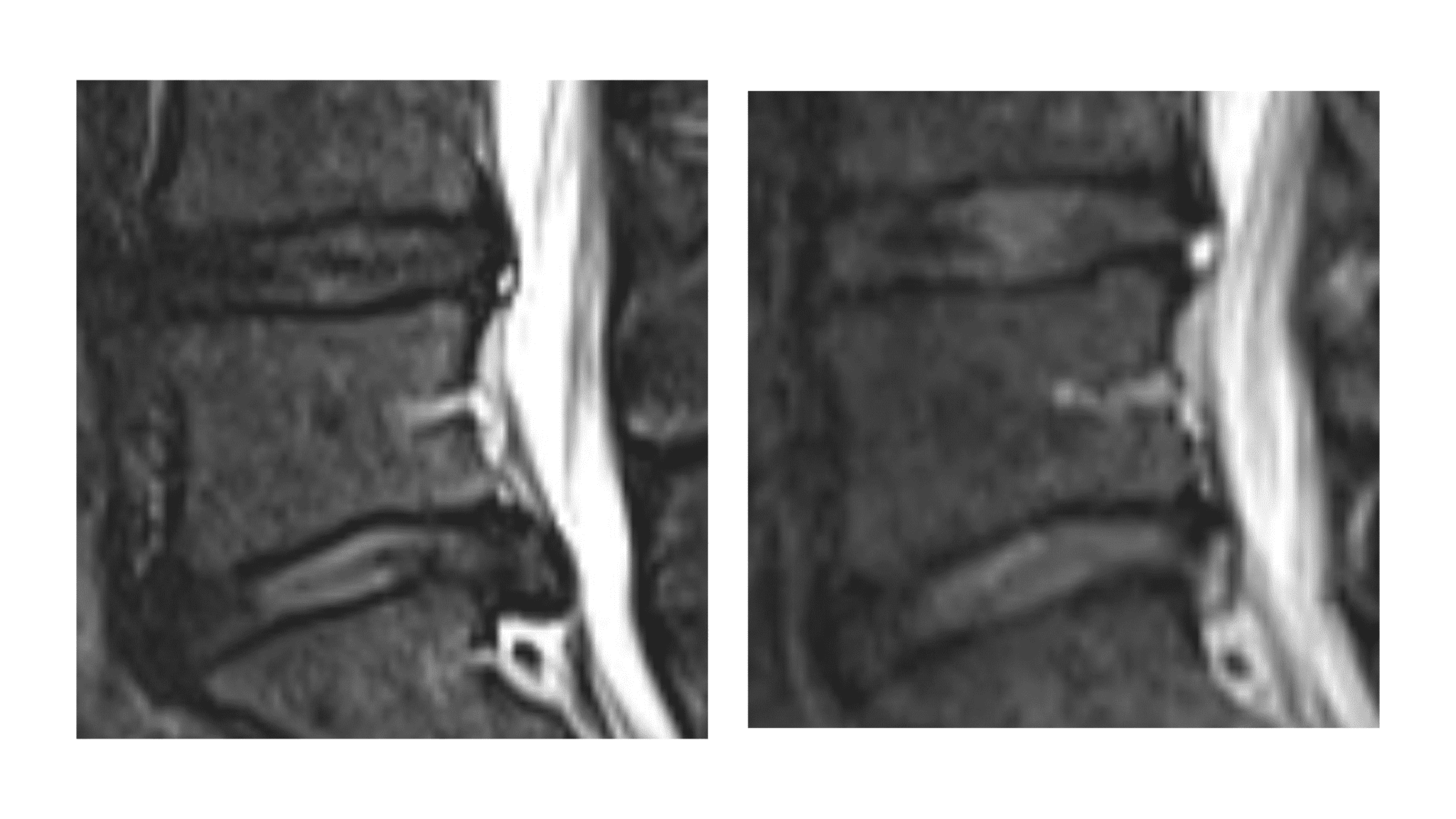 Avoiding Surgery In CrossFit Athletes with Herniated Disc - Regenexx