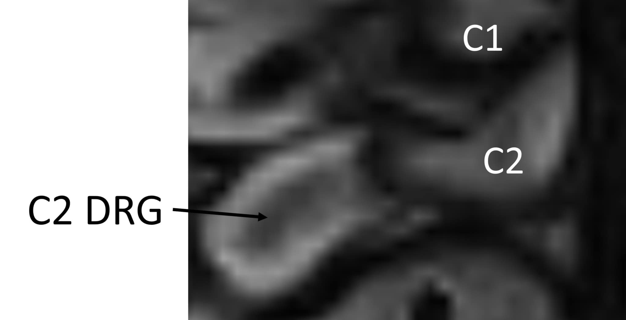 Can You Have Serious Neck Injuries and a "Normal" MRI? - Regenexx