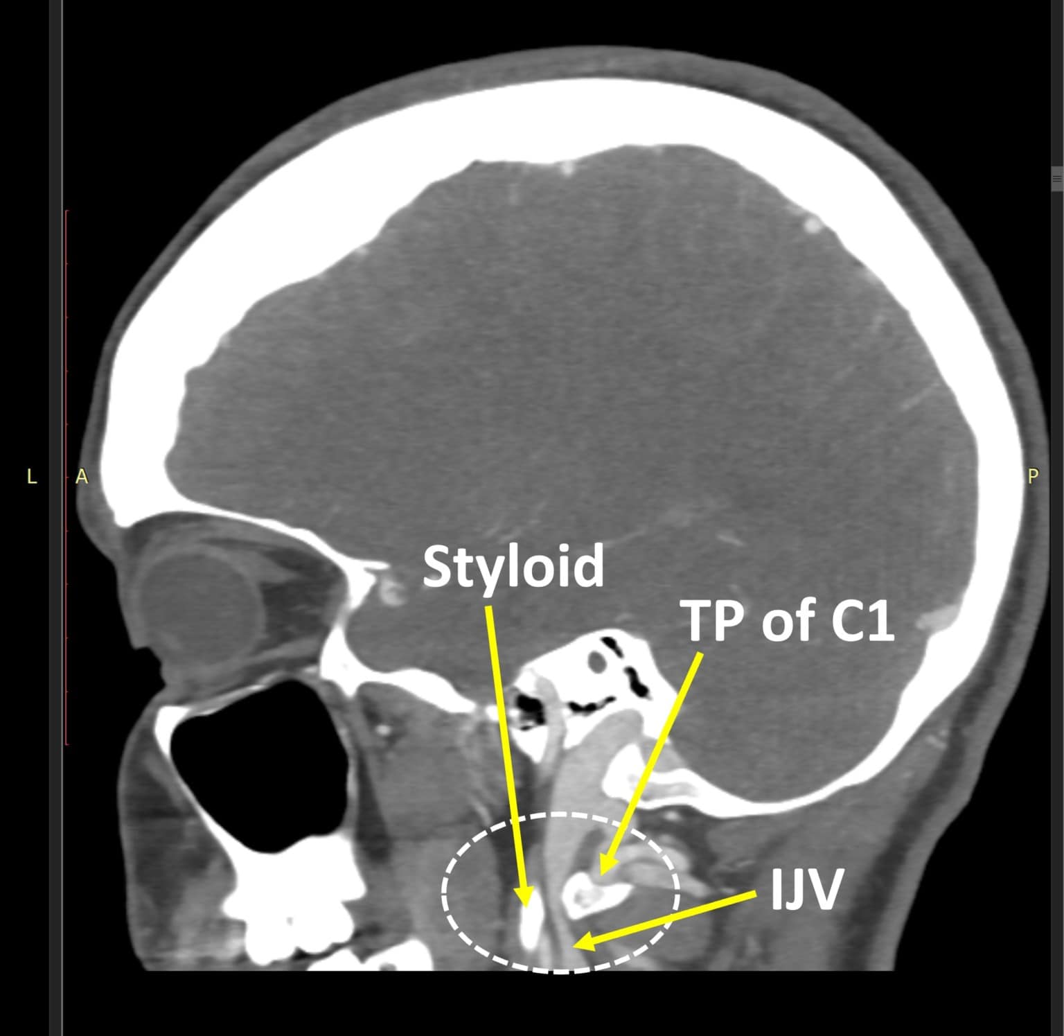 What is Intracranial Hypertension? What Does It Have to Do with the ...