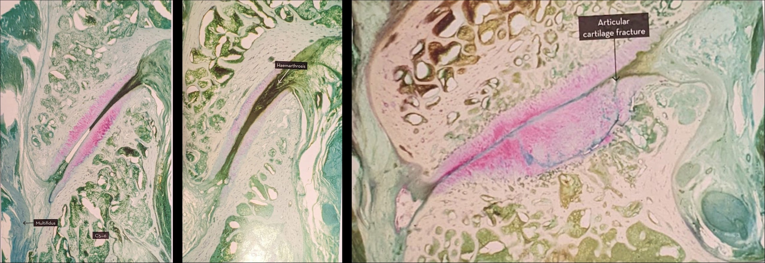 Can You Have Serious Neck Injuries and a "Normal" MRI? - Regenexx