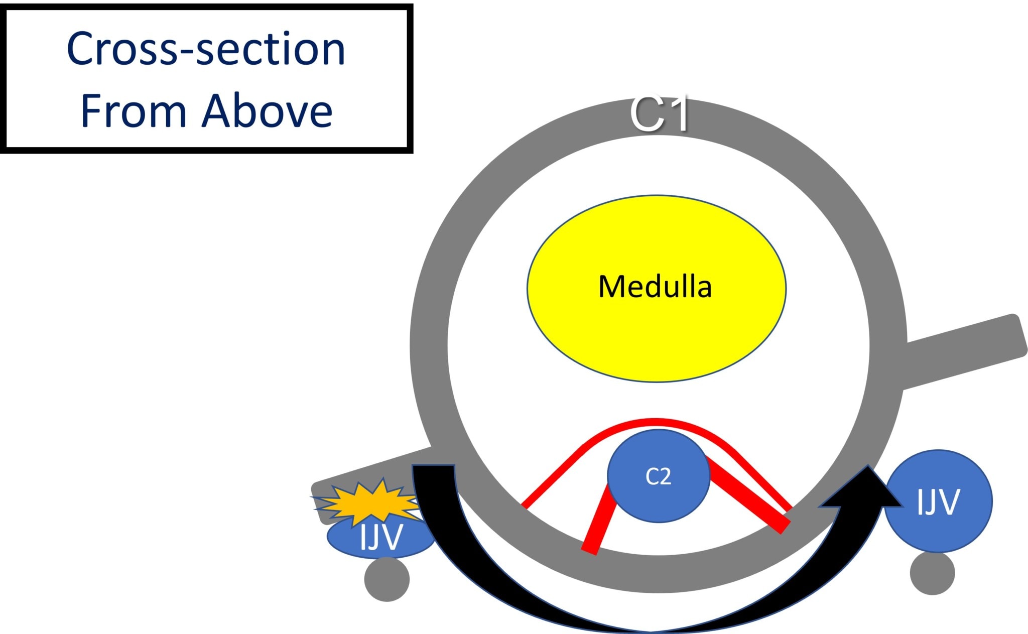 What is Intracranial Hypertension? What Does It Have to Do with the ...