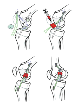 The BEAR Implant for ACL Tears - Regenexx
