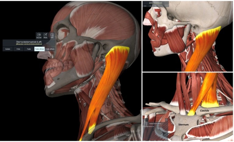 Sternocleidomastoid Syndrome: What You Need to Know - Regenexx