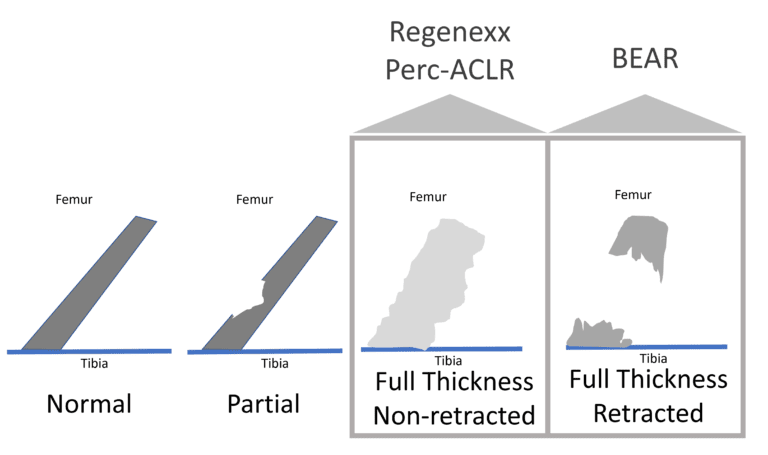 The BEAR Implant for ACL Tears - Regenexx