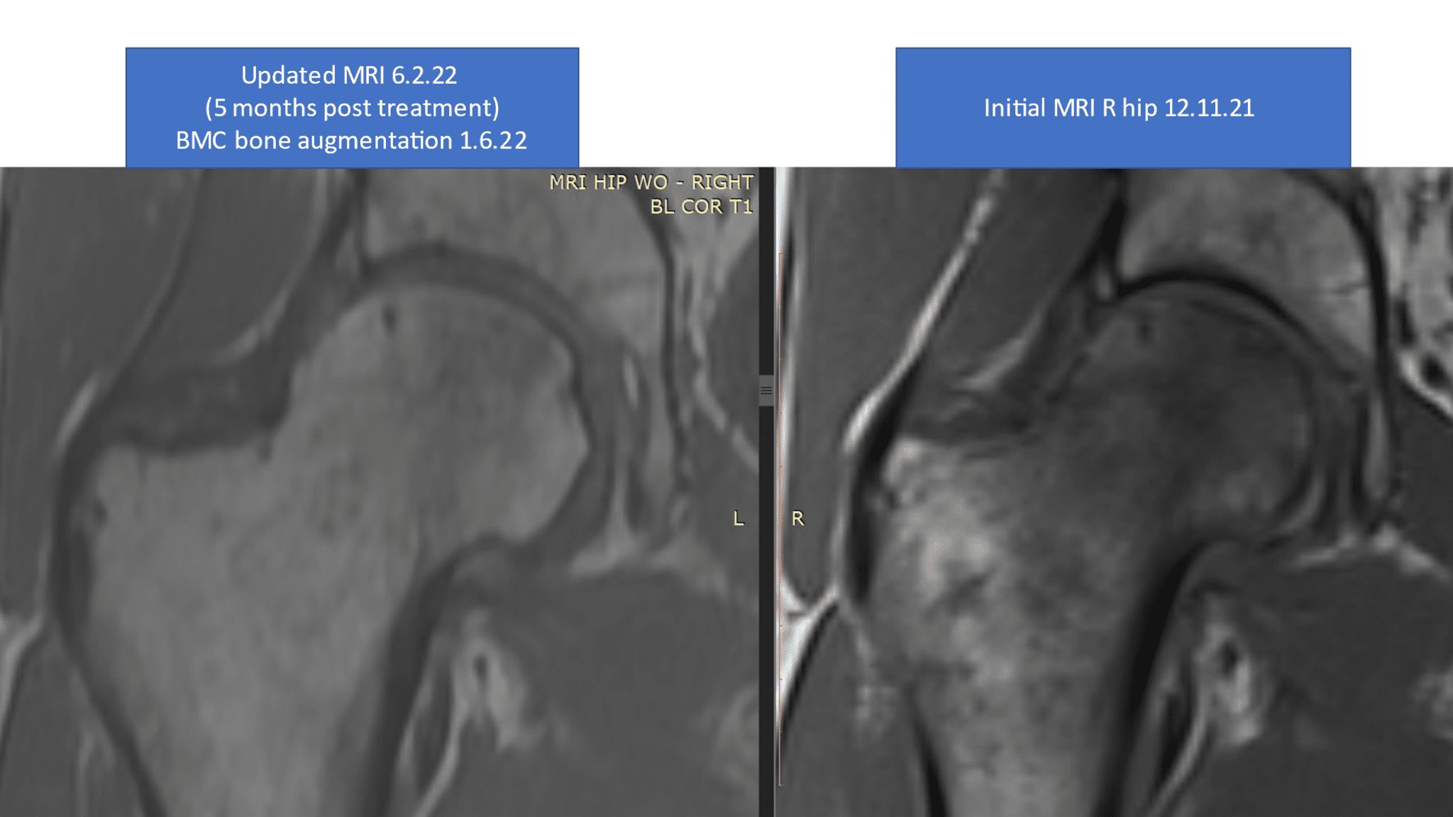 What Does Treating Hip AVN without Surgery Have to Do with the History ...