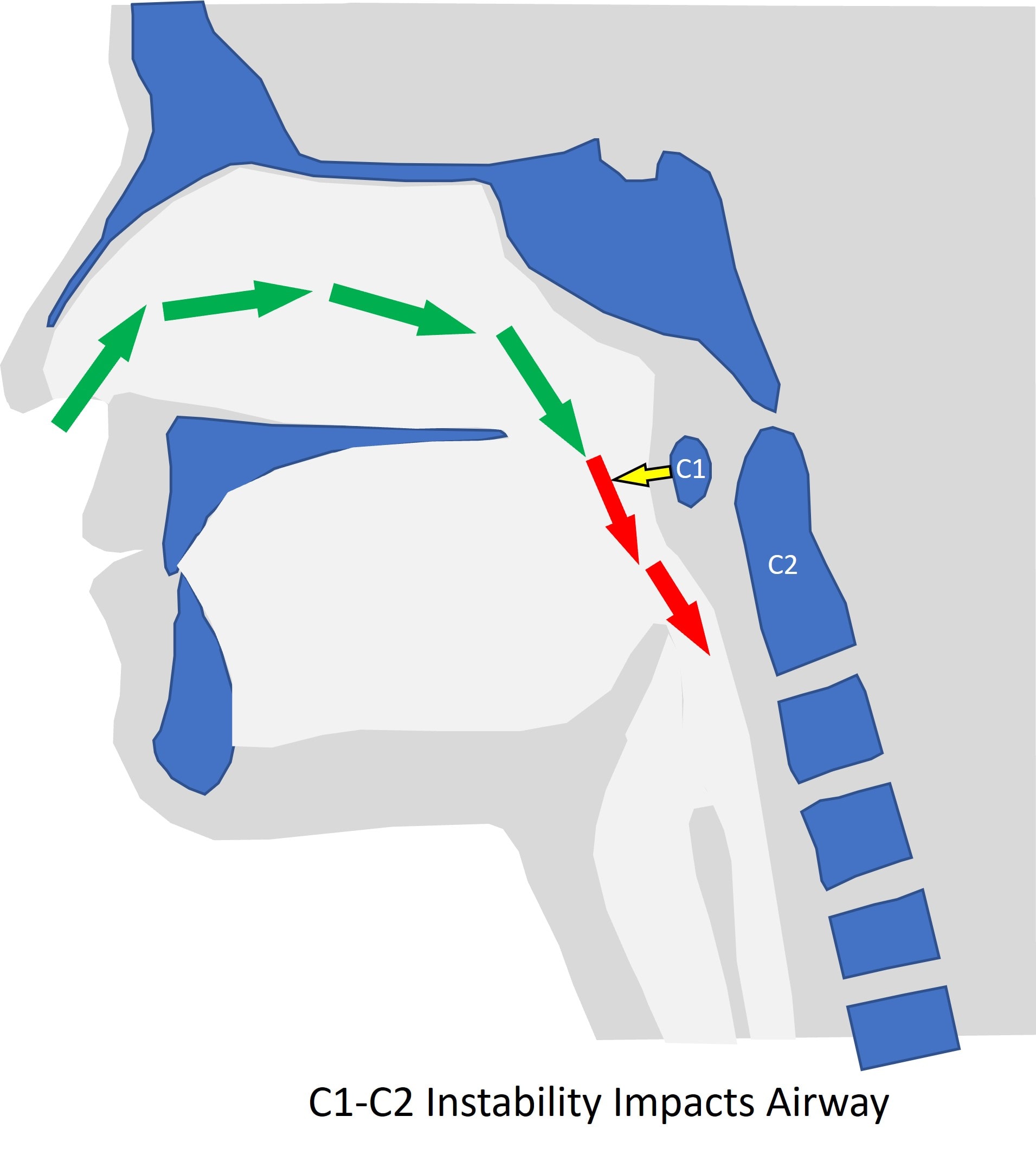 Is Your Snoring Being Caused by Your Neck? - Regenexx