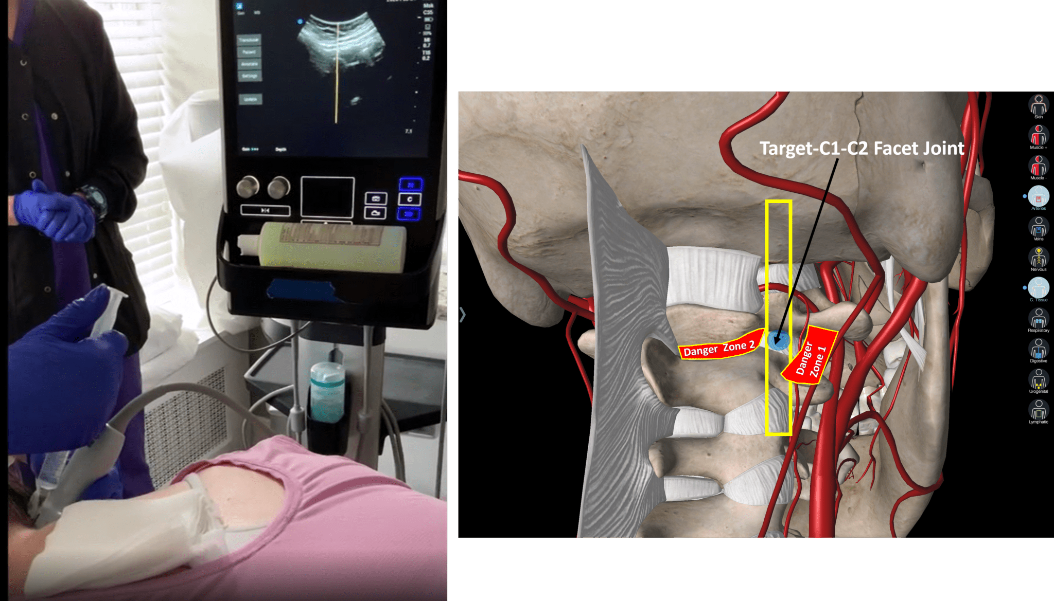 Injecting the C1-C2 Facet Joint Under Ultrasound: A PA with a Scary Big ...