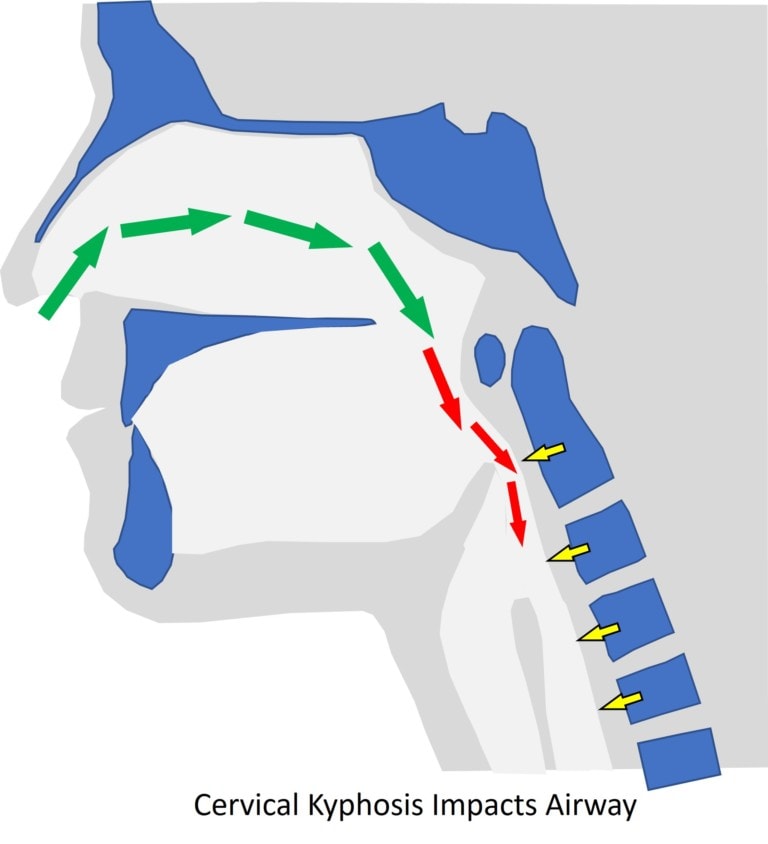 Is Your Snoring Being Caused by Your Neck? - Regenexx