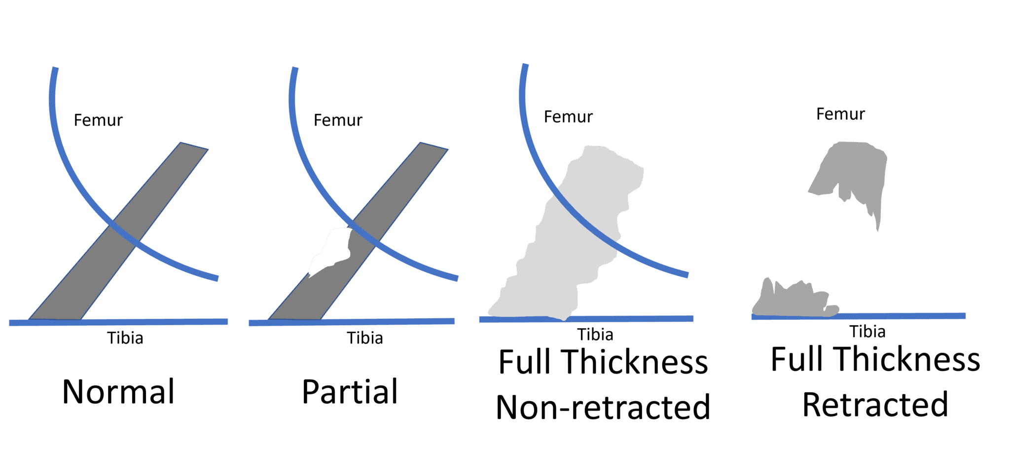 PRP Injections for Knee ACL Tears: A Few Sandwiches Short of a Picnic ...