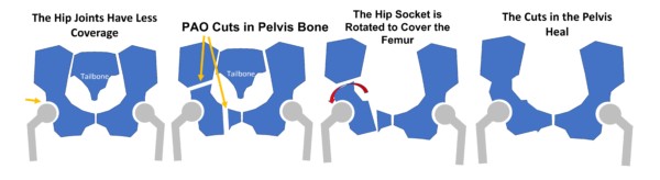 Periacetabular Osteotomy: Should You Get Hip PAO Surgery? - Regenexx