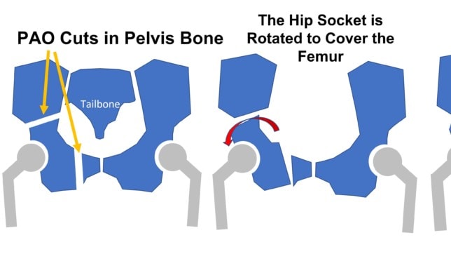 Hip Surgery Archives - Regenexx