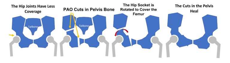 Periacetabular Osteotomy: Should You Get Hip PAO Surgery? - Regenexx
