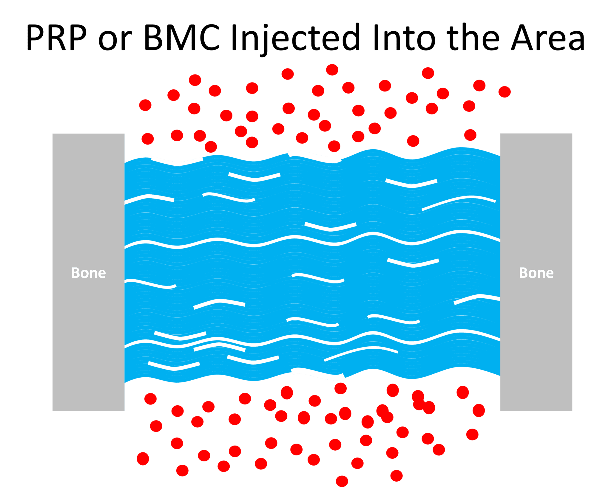 PRP Injections for Knee ACL Tears: A Few Sandwiches Short of a Picnic ...