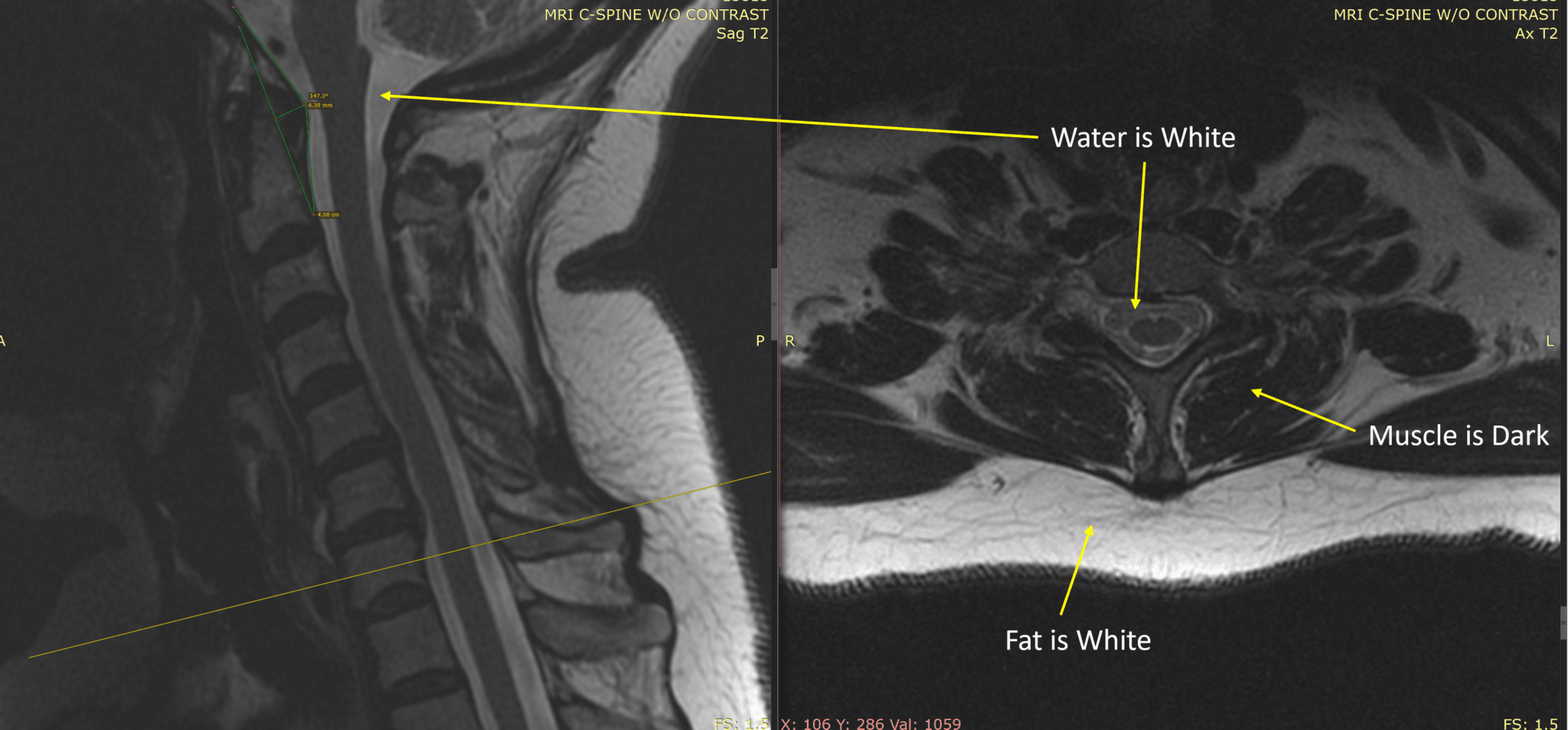 Cervical Multifidus Muscle Atrophy: A Literature Update - Regenexx