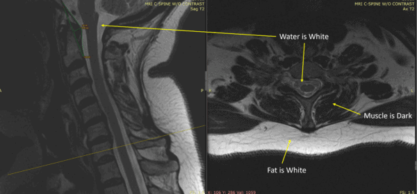 Cervical Multifidus Muscle Atrophy: A Literature Update - Regenexx