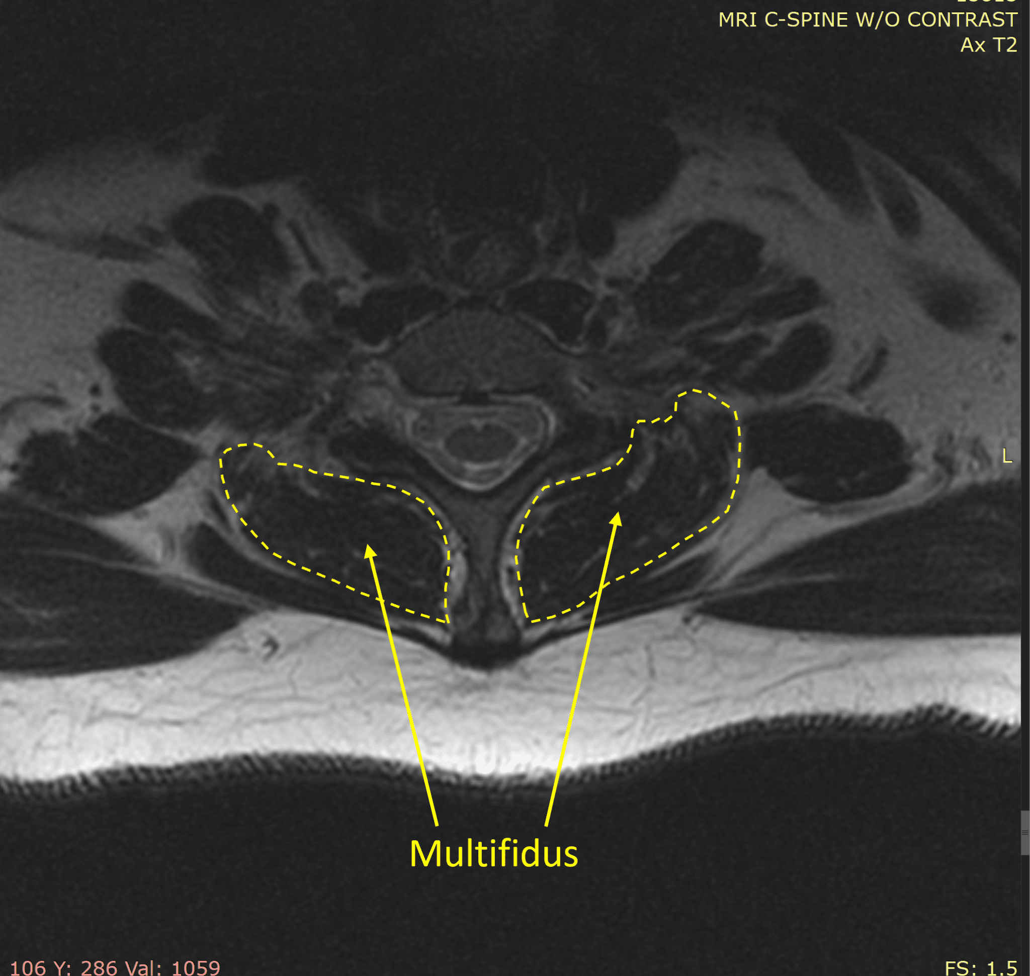 Cervical Multifidus Muscle Atrophy: A Literature Update - Regenexx