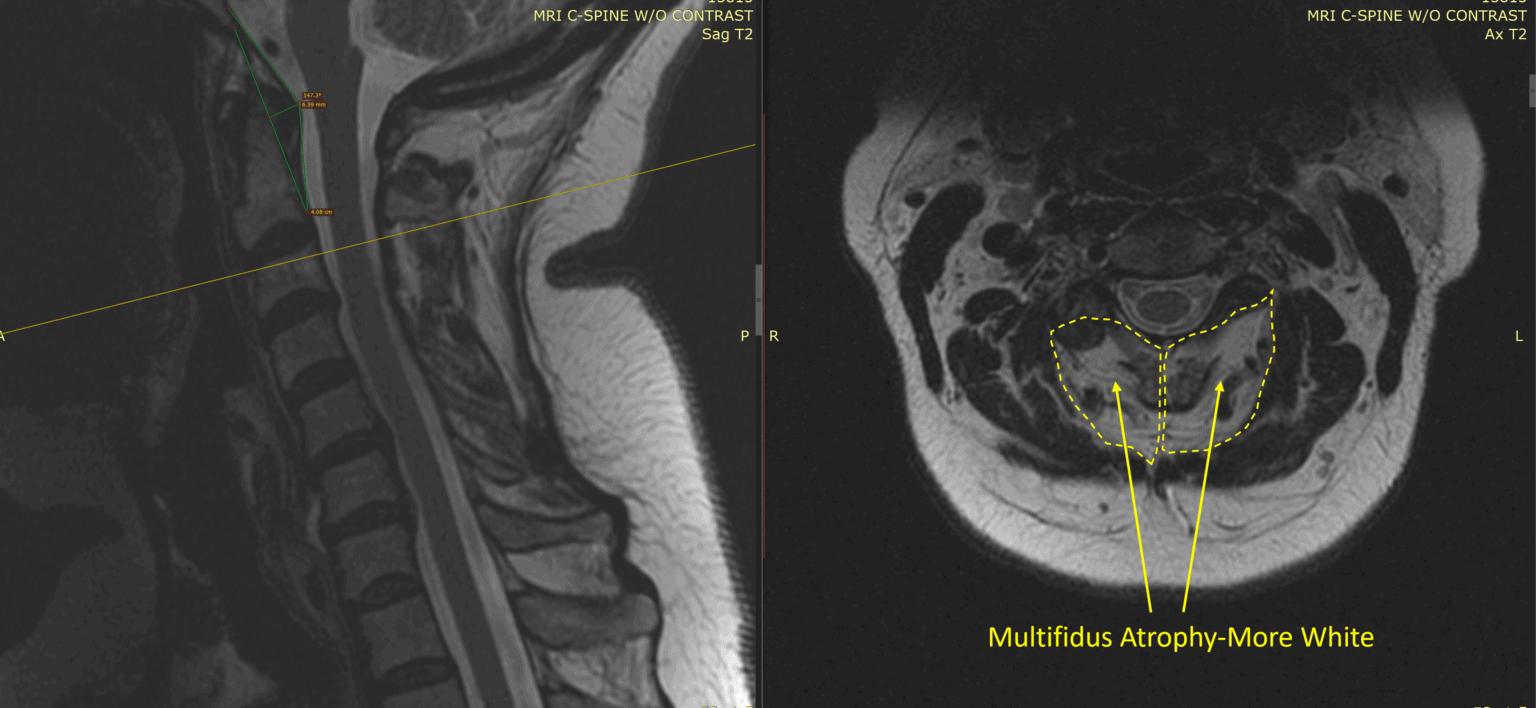 Cervical Multifidus Muscle Atrophy: A Literature Update - Regenexx