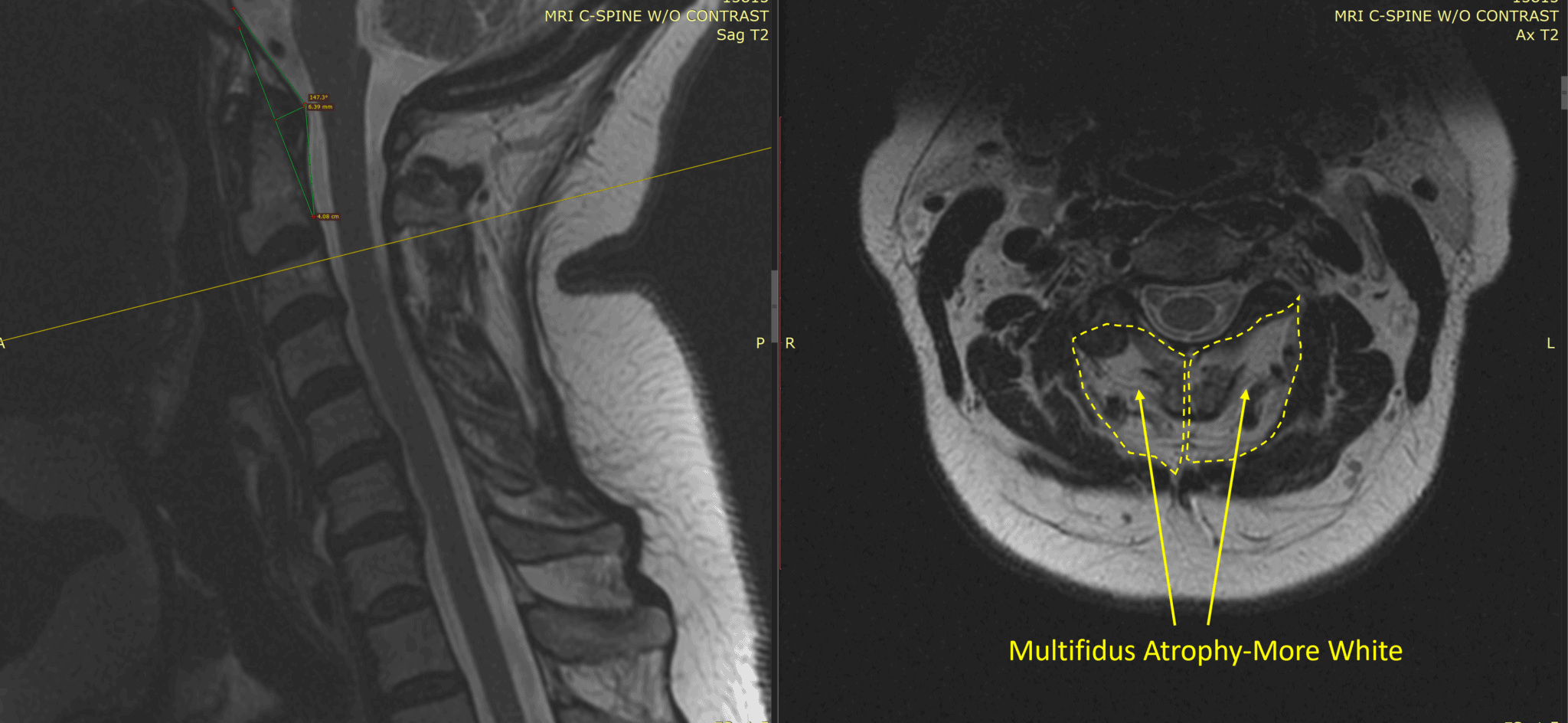 Cervical Multifidus Muscle Atrophy: A Literature Update - Regenexx