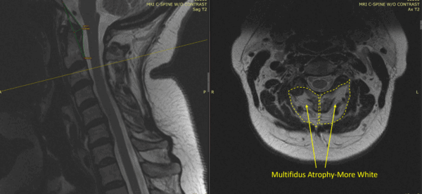 Cervical Multifidus Muscle Atrophy: A Literature Update - Regenexx