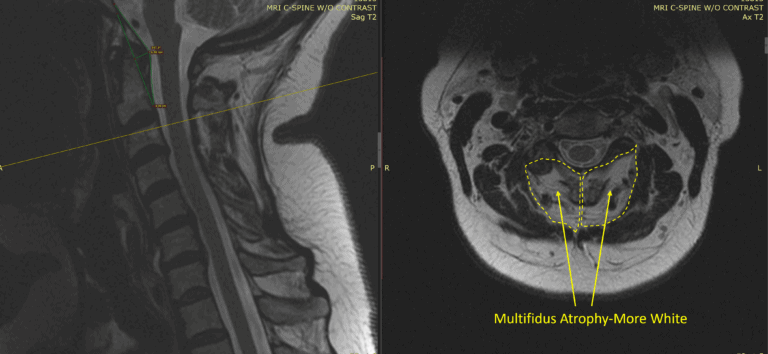 Cervical Multifidus Muscle Atrophy: A Literature Update - Regenexx