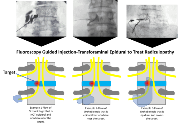 Fluoroscopy vs Ultrasound for Orthobiologic Spine Procedures - Regenexx