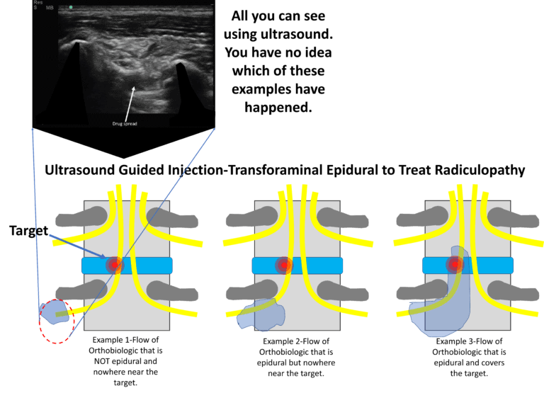 Fluoroscopy vs Ultrasound for Orthobiologic Spine Procedures - Regenexx