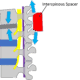 Interspinous Spacers: The Best Thing Since Sliced Bread or a Bad Idea ...