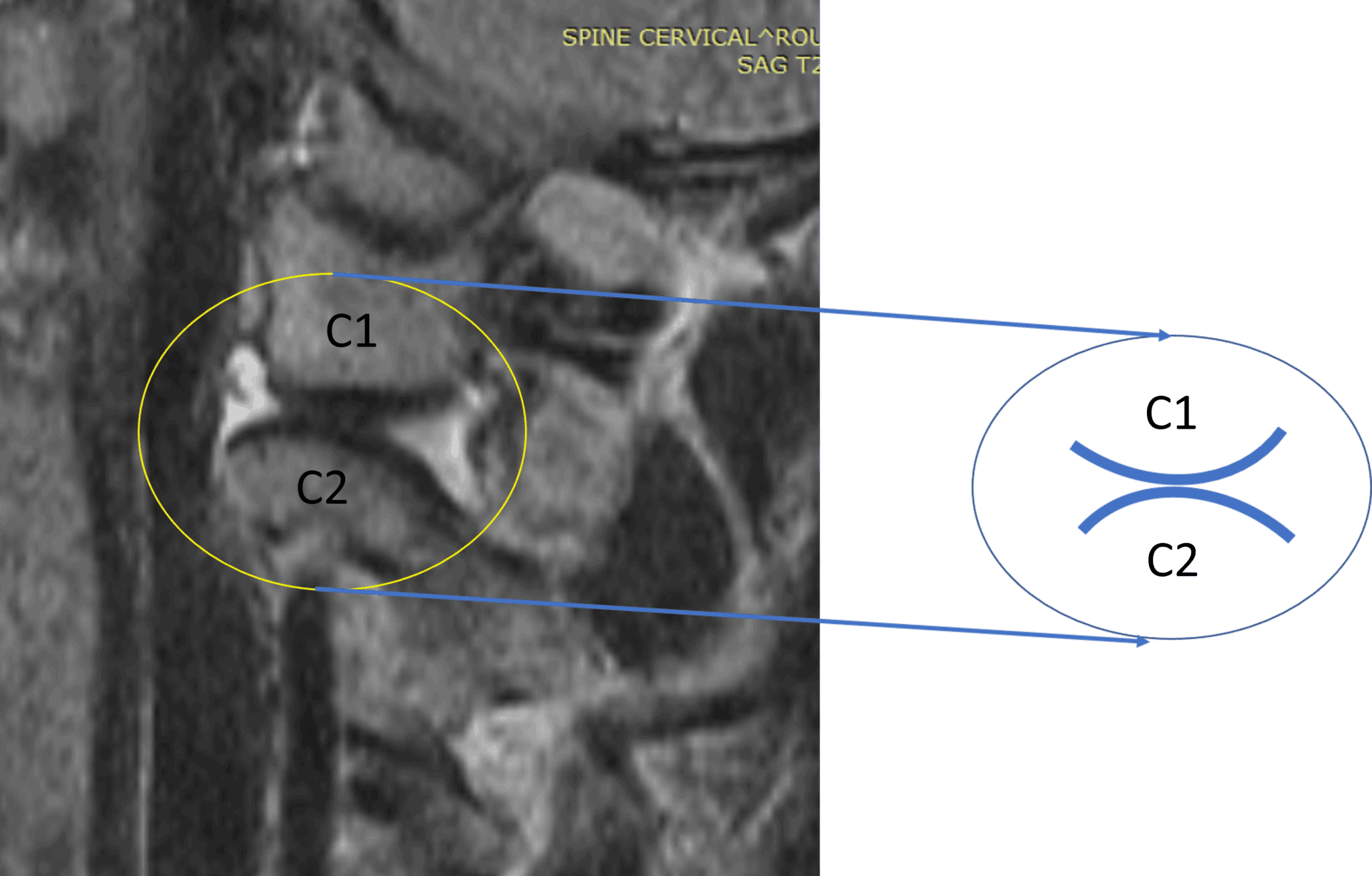 How Does the Body Stabilize the C1-C2 Joint? The Role of the Alar ...