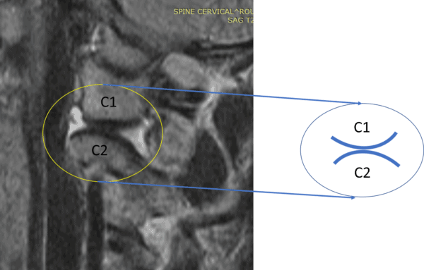 How Does the Body Stabilize the C1-C2 Joint? The Role of the Alar ...