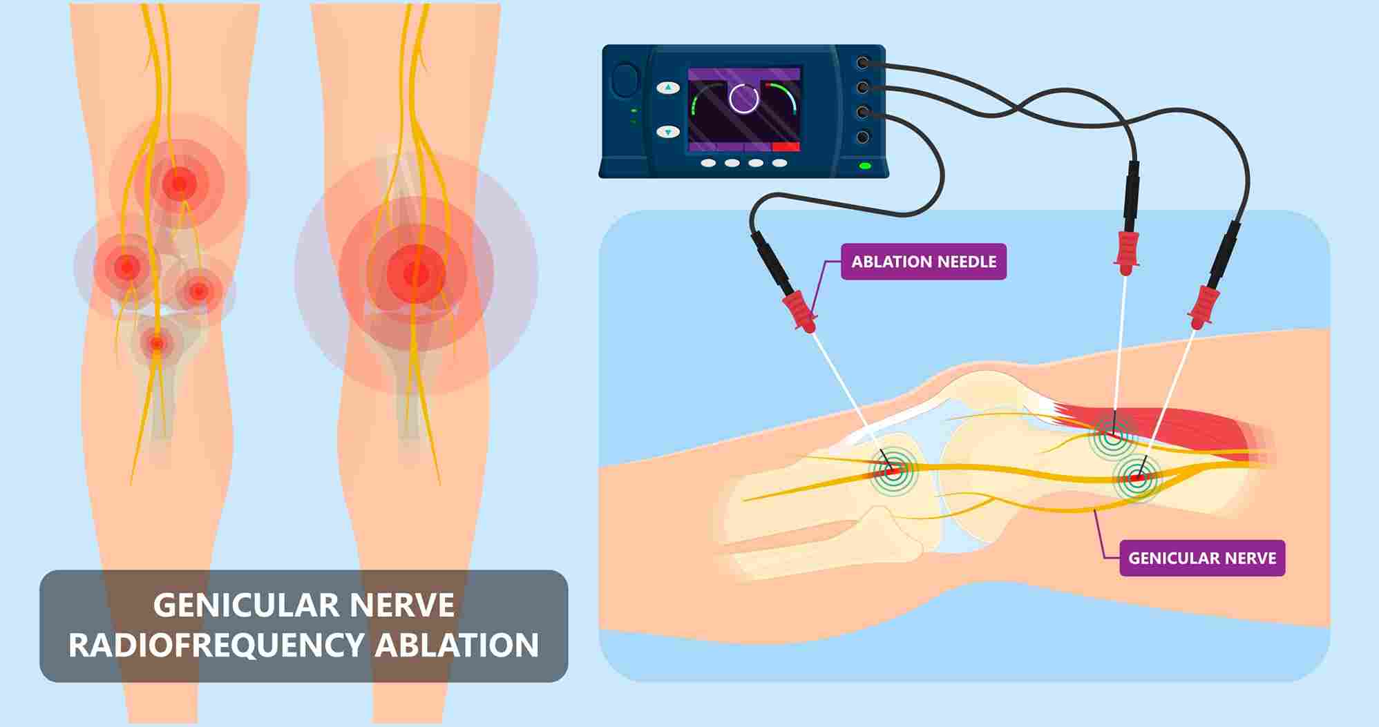 Radiofrequency Neurotomy Of The Knee What Could Go Wrong Regenexx Radiofrequency Neurotomy Of The Knee What Could Go Wrong Regenexx