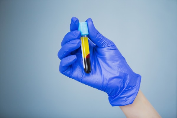 Are You Getting Ripped Off by Paying for a Low Dose PRP Shot? - Regenexx