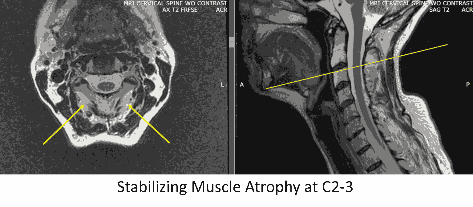 How Does the Body Stabilize the C1-C2 Joint? The Role of the Alar ...