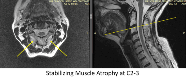 How Does the Body Stabilize the C1-C2 Joint? The Role of the Alar ...