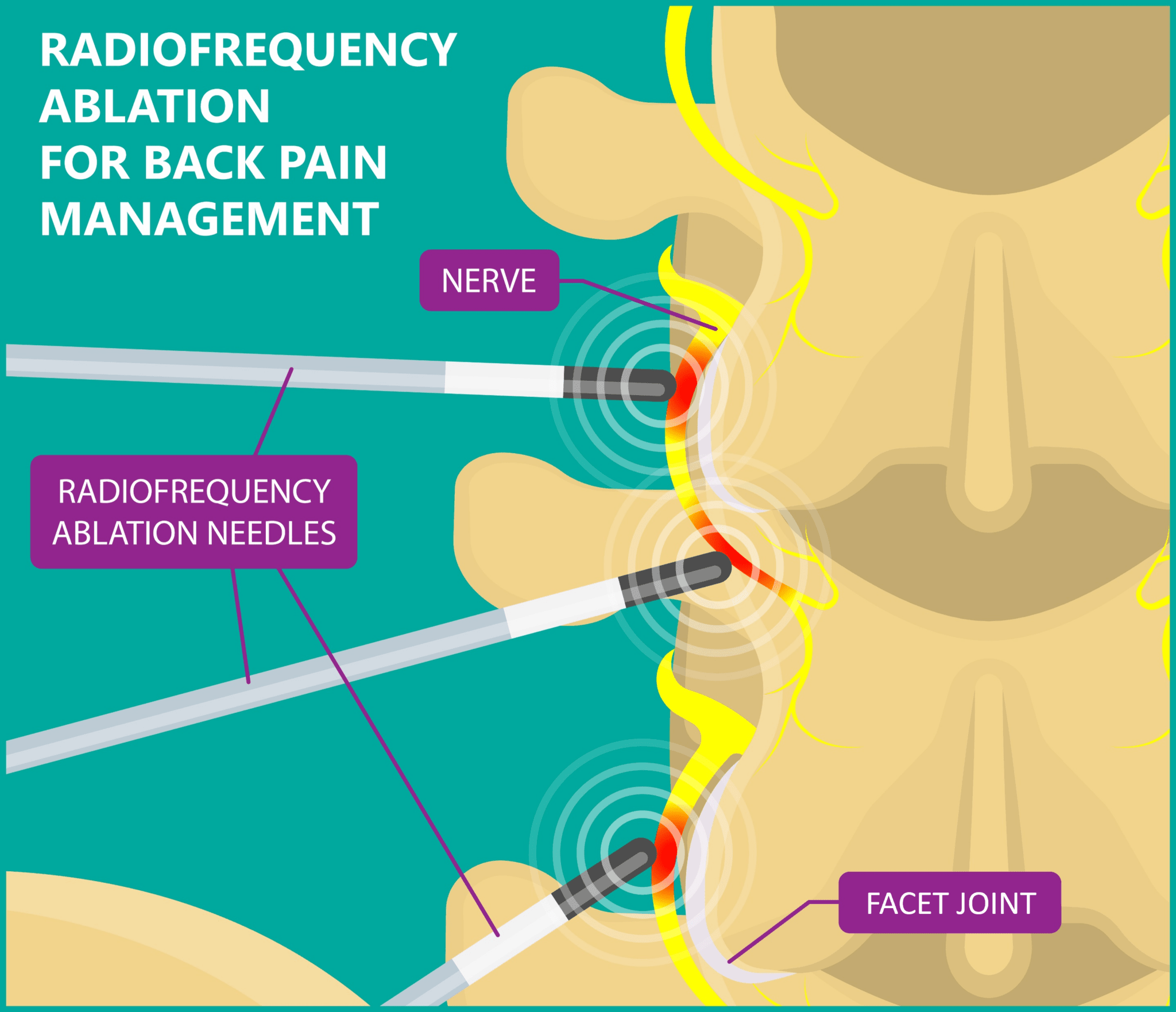 RFA Is Contraindicated in Cases of Spinal Instability - Regenexx