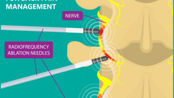 Radiofrequency Ablation Insights & Treatment Updates