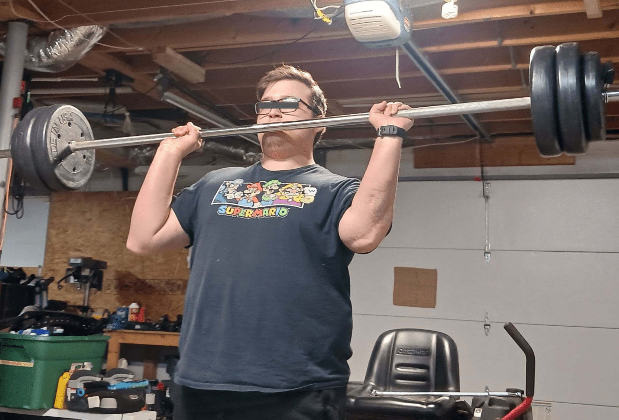 Can an Intraosseous BMC Injection Mend a Non-healing Bone? - Regenexx