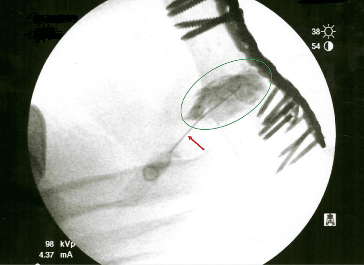 Can an Intraosseous BMC Injection Mend a Non-healing Bone? - Regenexx