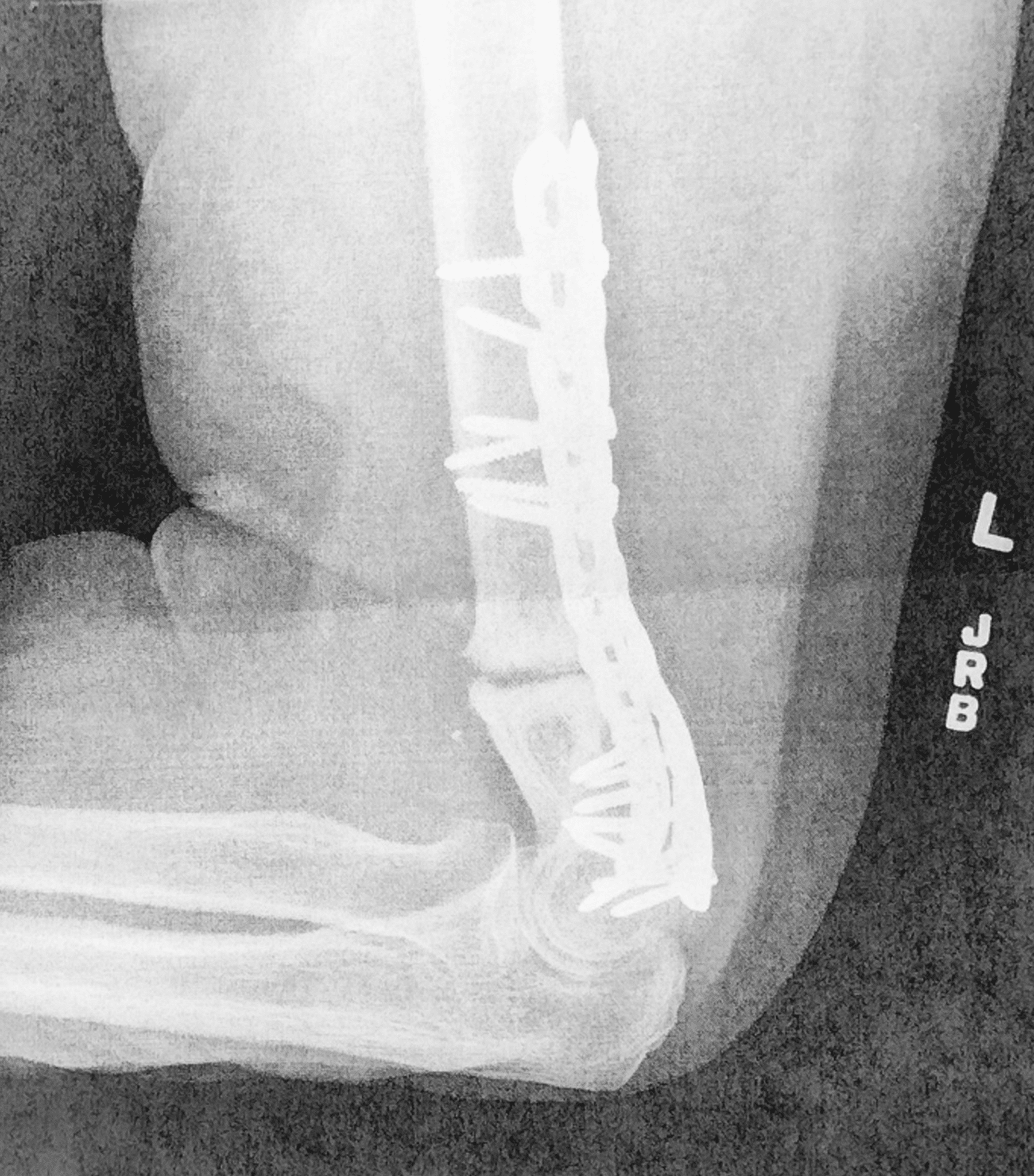 Can an Intraosseous BMC Injection Mend a Non-healing Bone? - Regenexx