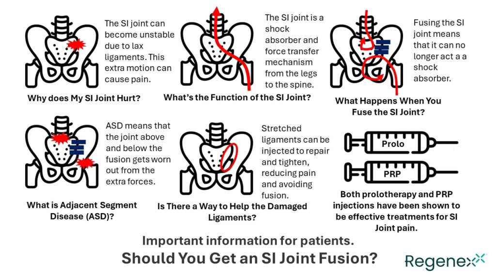 Should You Get an SI Fusion? - Regenexx