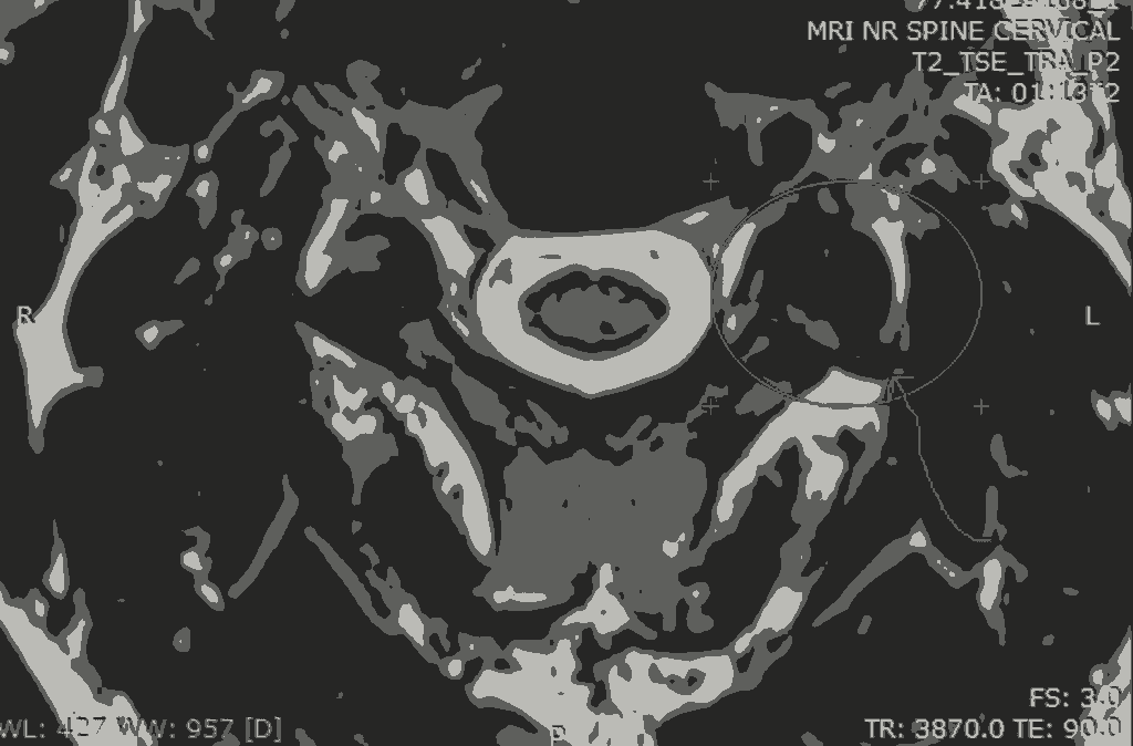 Treating the Cervical Spine Like It's 1999! - Regenexx