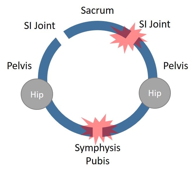 What Is Osteitis Pubis? Key Facts About This Pelvic Condition