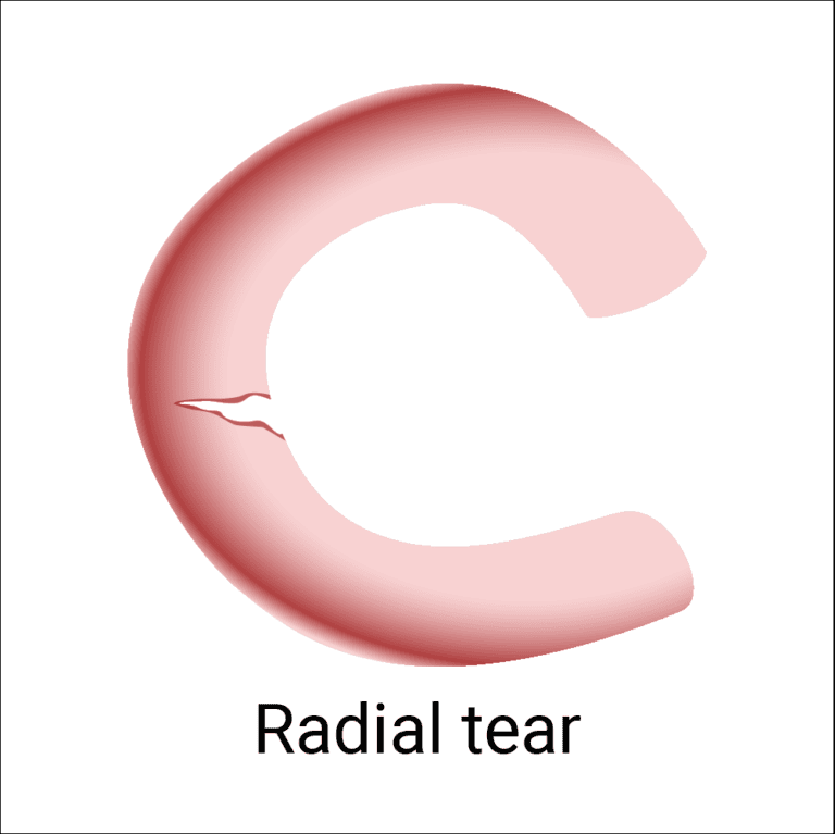 Types of Meniscus Tears: Causes, Symptoms, and Solutions