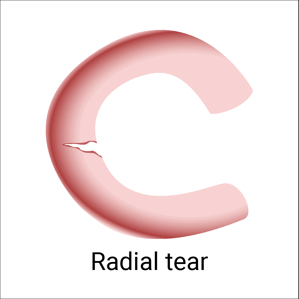 Types of Meniscus Tears: Causes, Symptoms, and Solutions