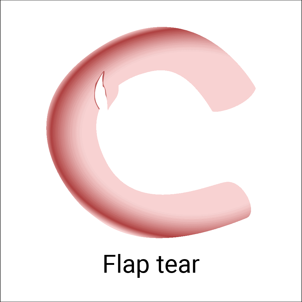 Types of Meniscus Tears: Causes, Symptoms, and Solutions