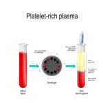 PRP Injection for Knee Pain - Regenexx-SCP Advanced Treatment