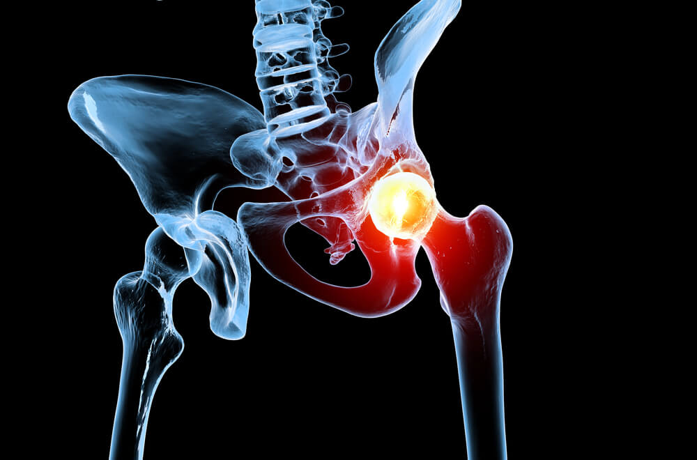 What Is Hip Osteoarthritis? Causes, Symptoms, And Treatments